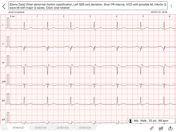 First Aid FDA Approved White Smart 12-lead ECG Wirelessly with iPad ECG ...
